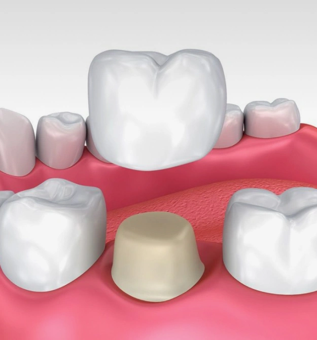 Porcelain Dental Crowns Fort Worth, TX | Centreport Smiles